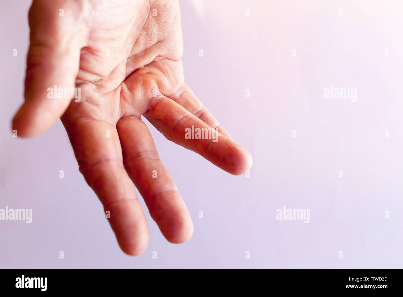 Hand of an man with Dupuytren contracture Stock Photo - Alamy