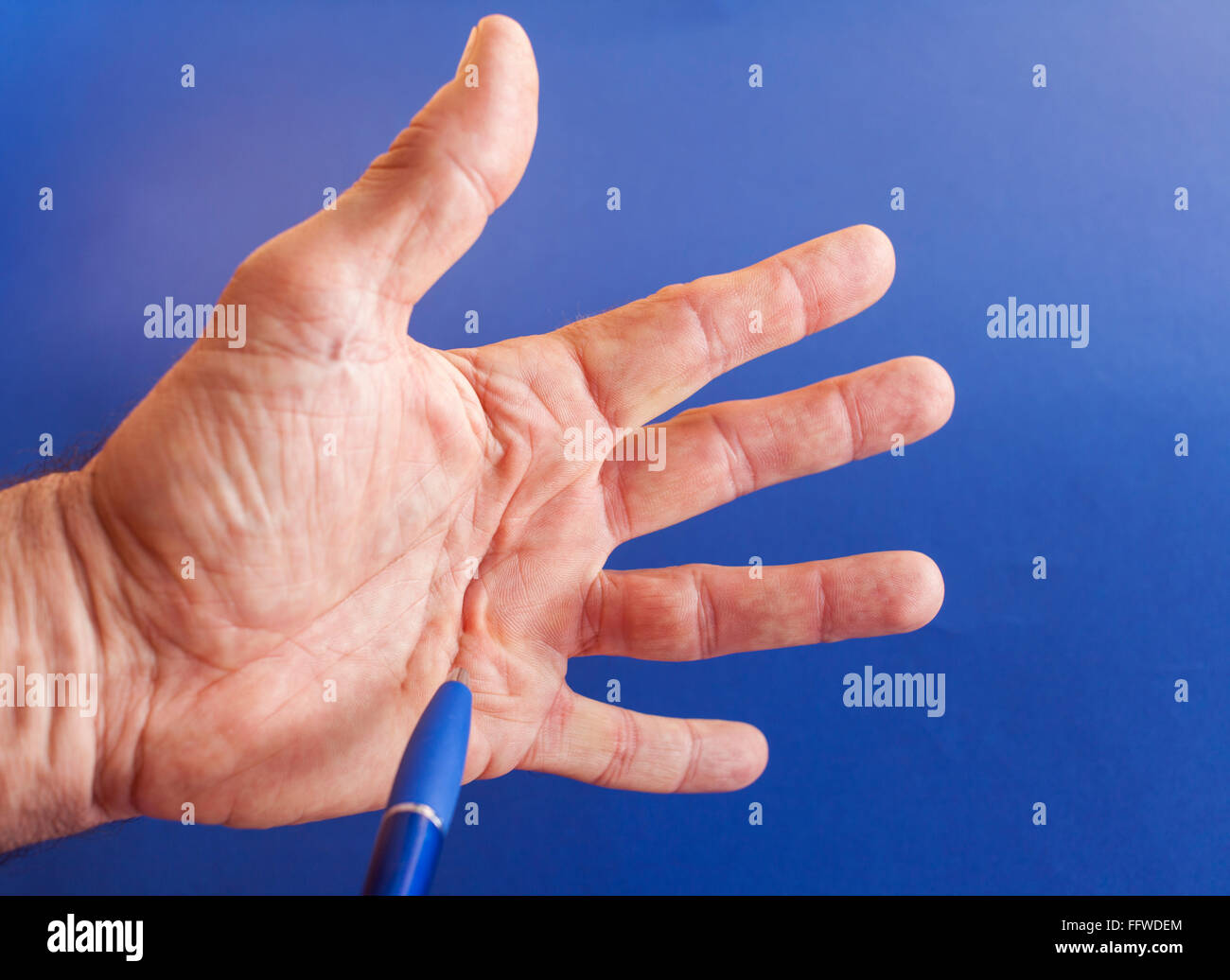 Dupuytrens contracture hand surgery hi-res stock photography and images ...