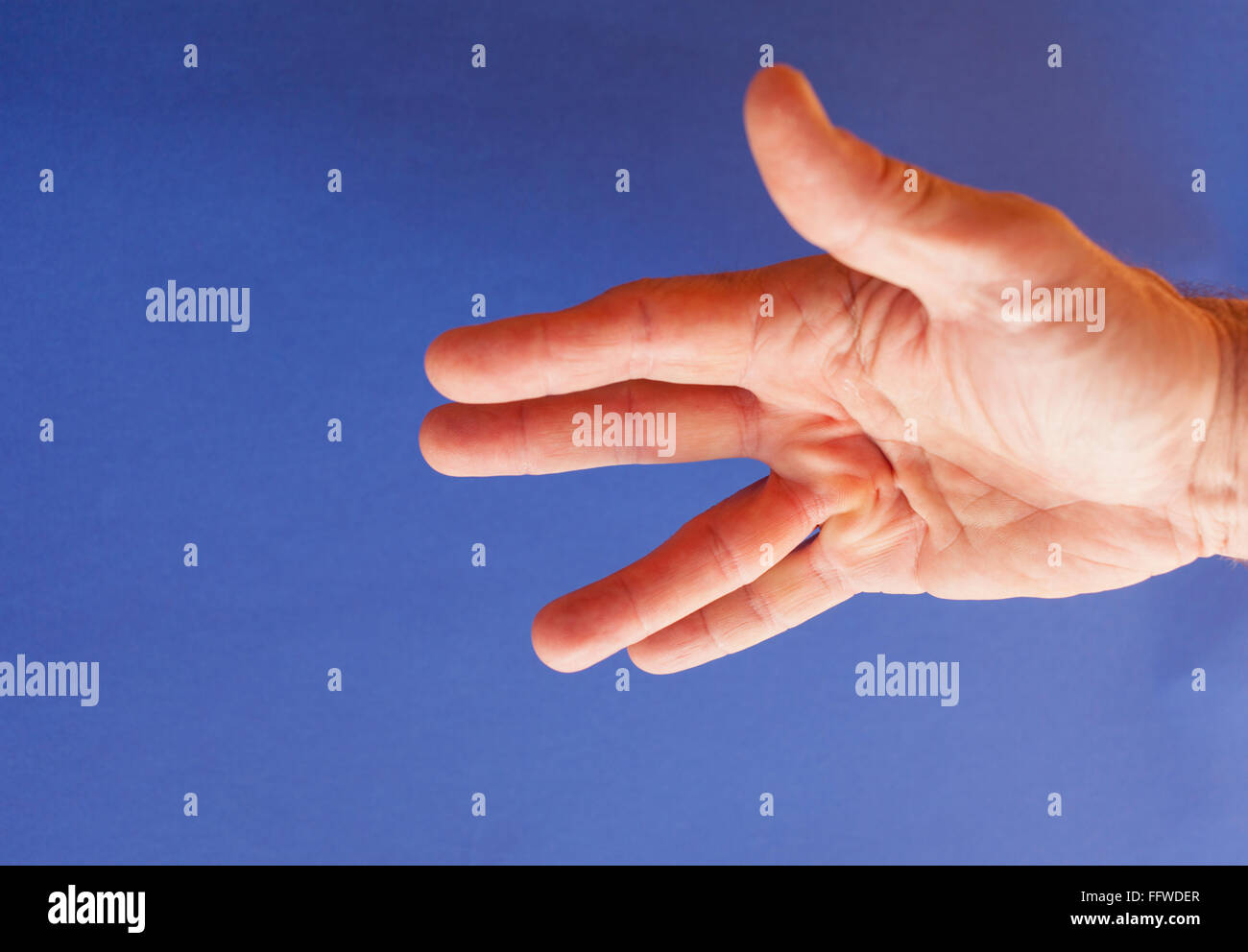 Hand of an man with Dupuytren contracture on blue Stock Photo - Alamy