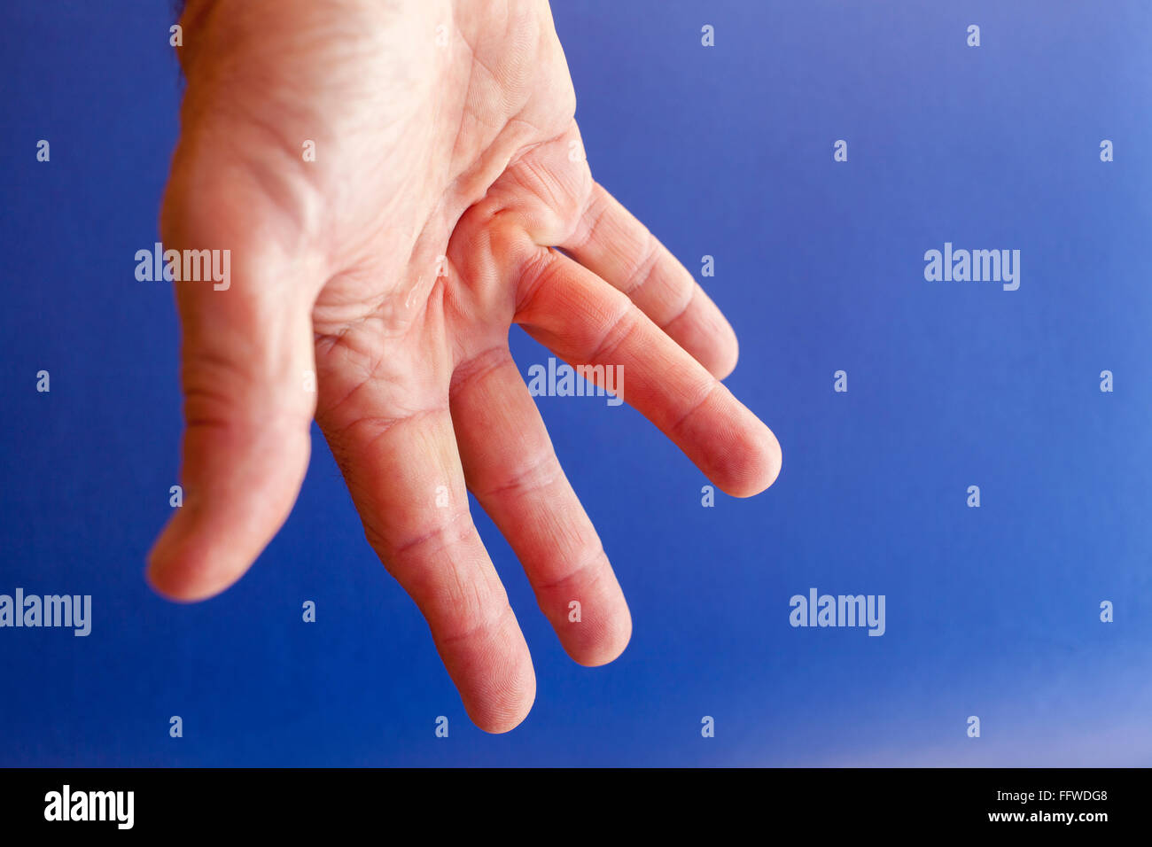 Dupuytrens contracture hand surgery hi-res stock photography and images ...