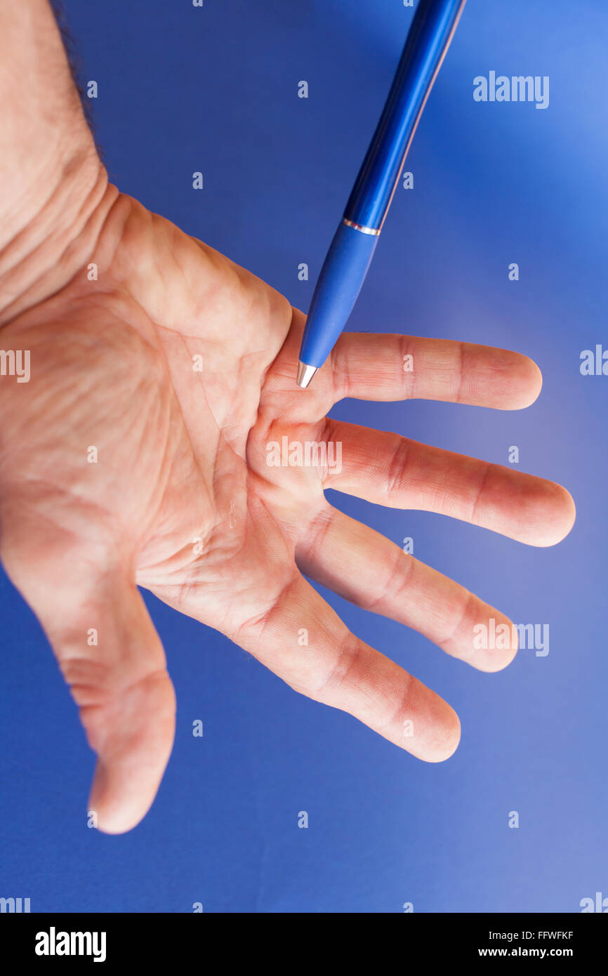 Hand of an man with Dupuytren contracture Stock Photo - Alamy