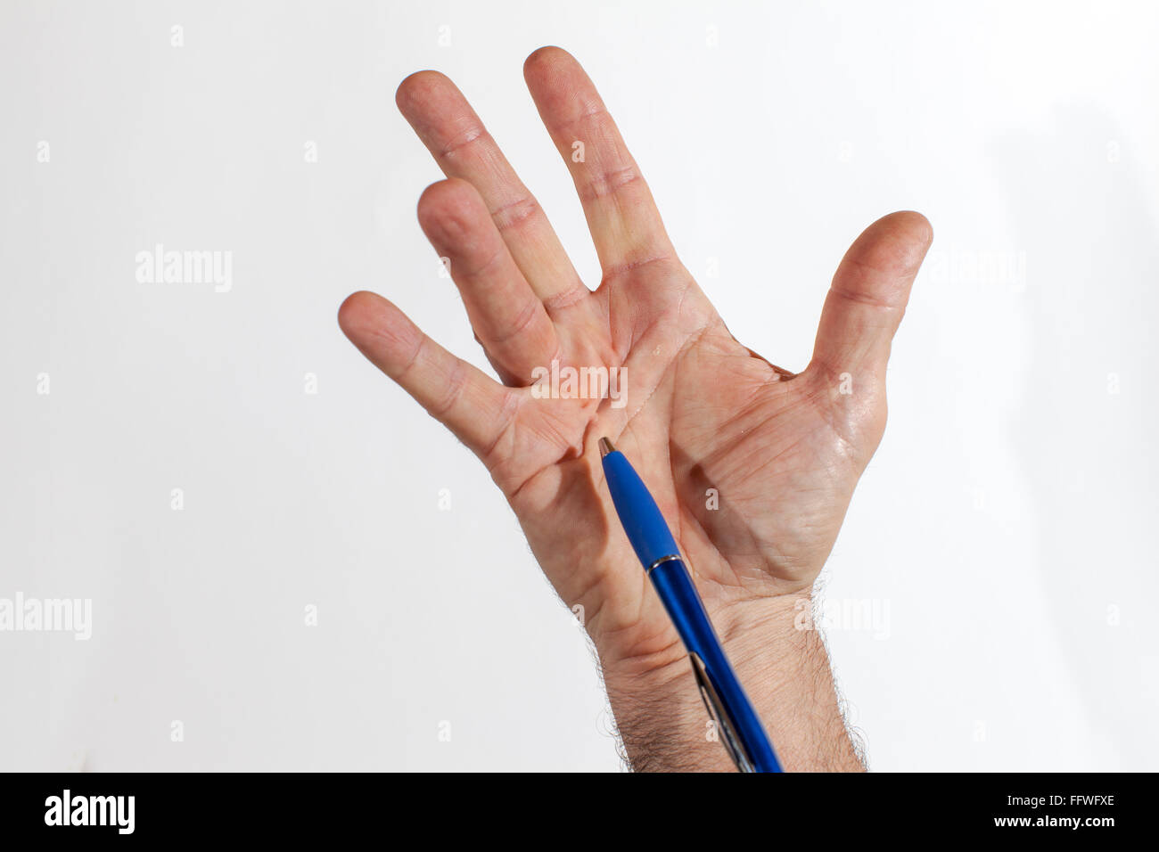 Hand of an man with Dupuytren contracture Stock Photo - Alamy