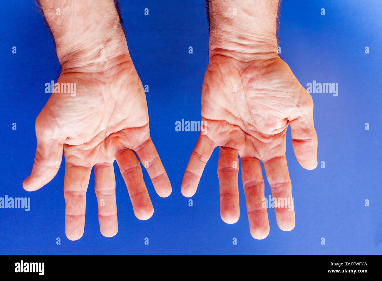 Hands of an man with Dupuytren contracture Stock Photo - Alamy