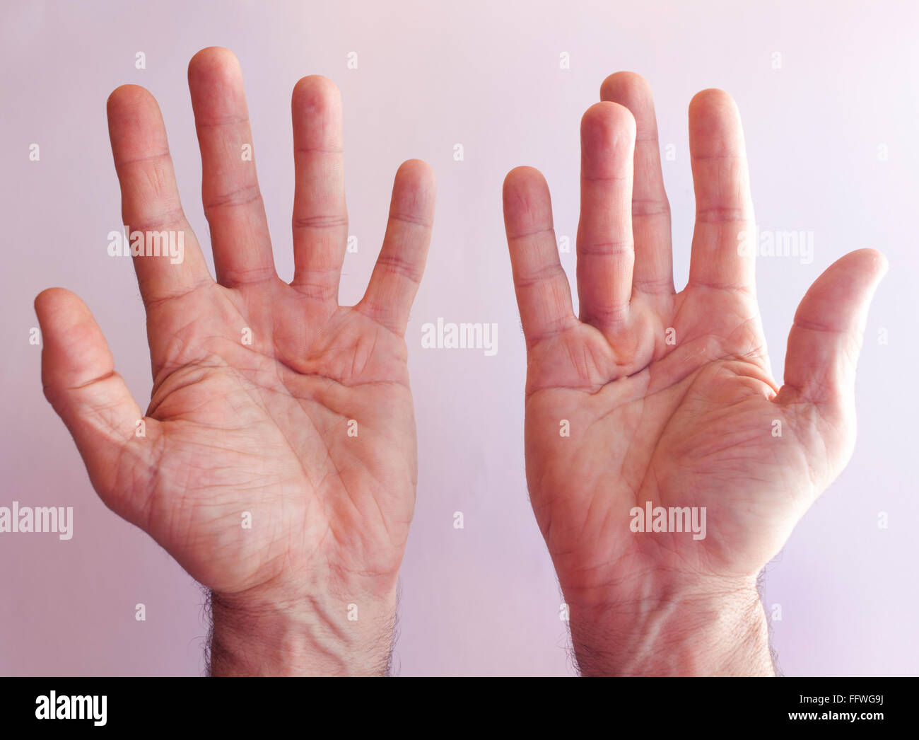Hands of an man with Dupuytren contracture Stock Photo - Alamy