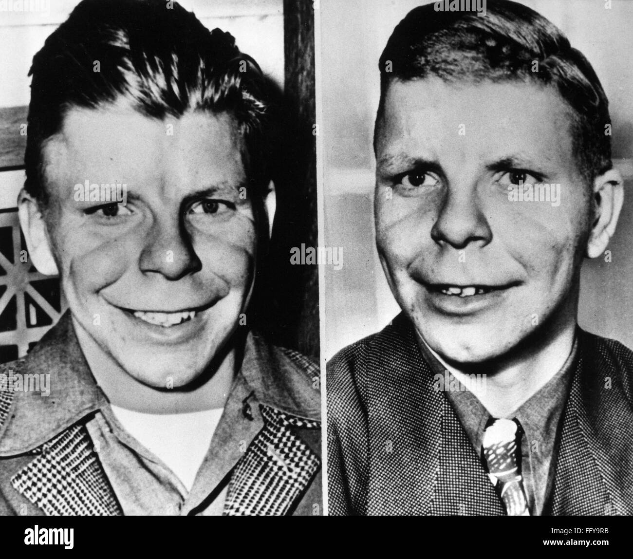 PLASTIC SURGERY, 1947. /nDavid Ruge, age 16, of Chicago, Illinois ...