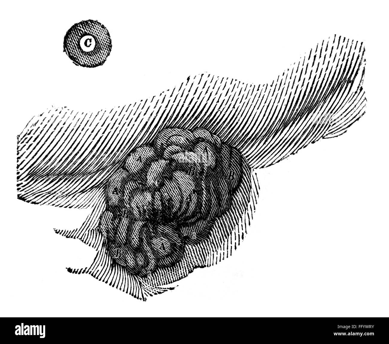 ST. MARTIN'S FISTULA. /nIllustration by William Beaumont showing the ...