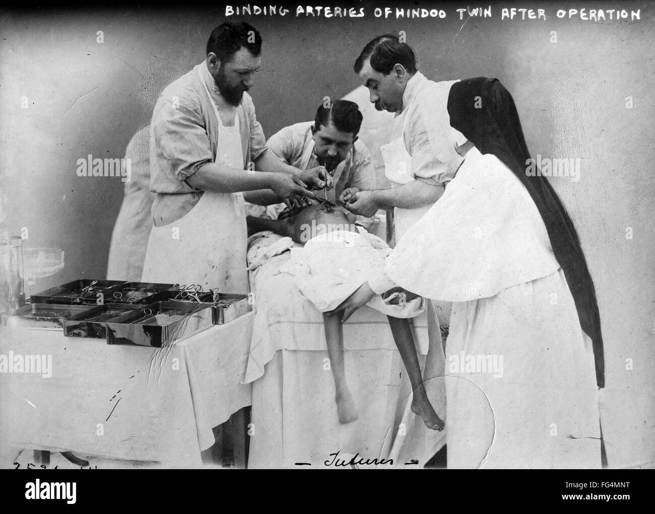 CONJOINED TWINS, 1902. /nEugΦne-Louis Doyen and his colleagues ...