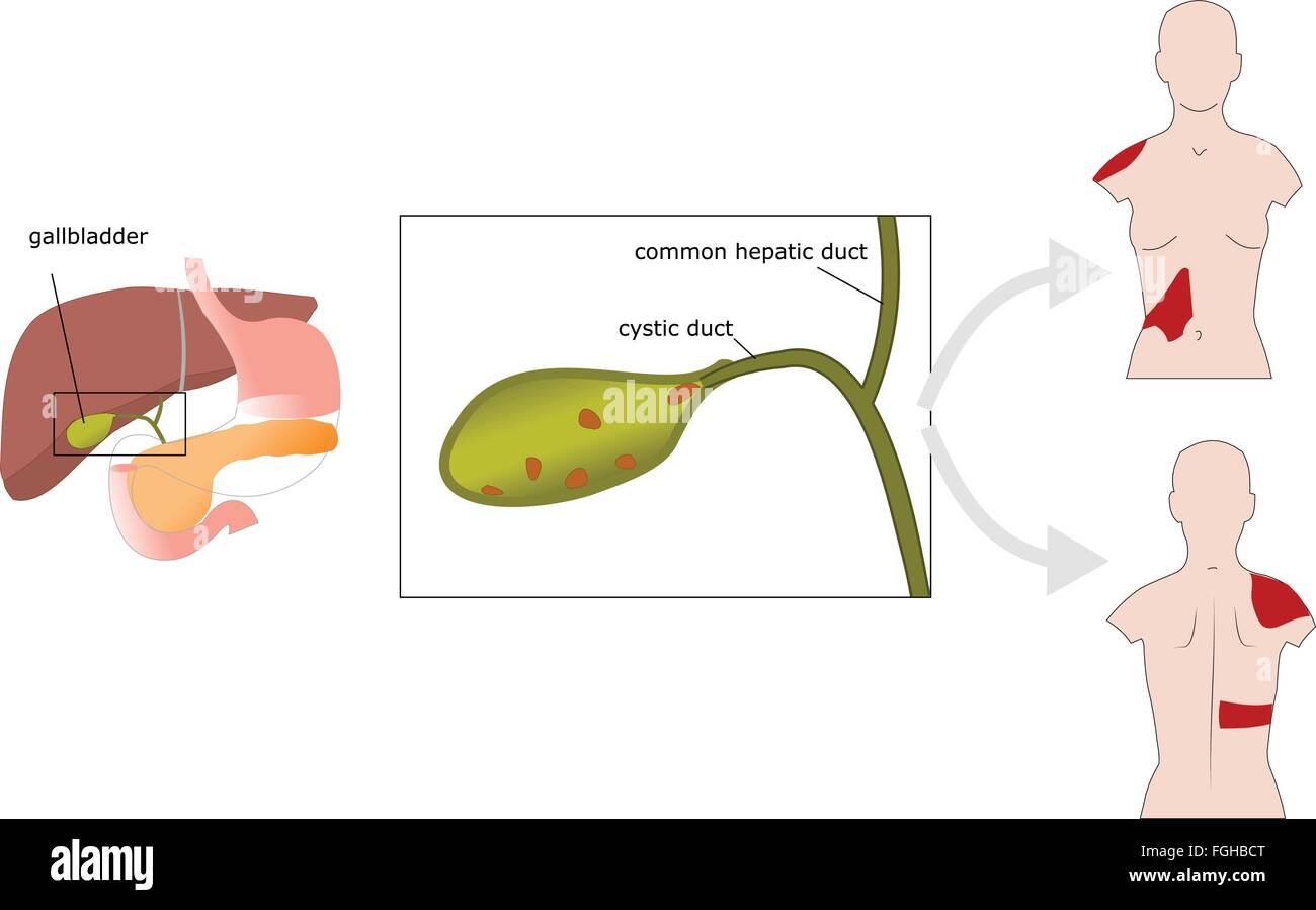 Gallstones surgery High Resolution Stock Photography and Images - Alamy