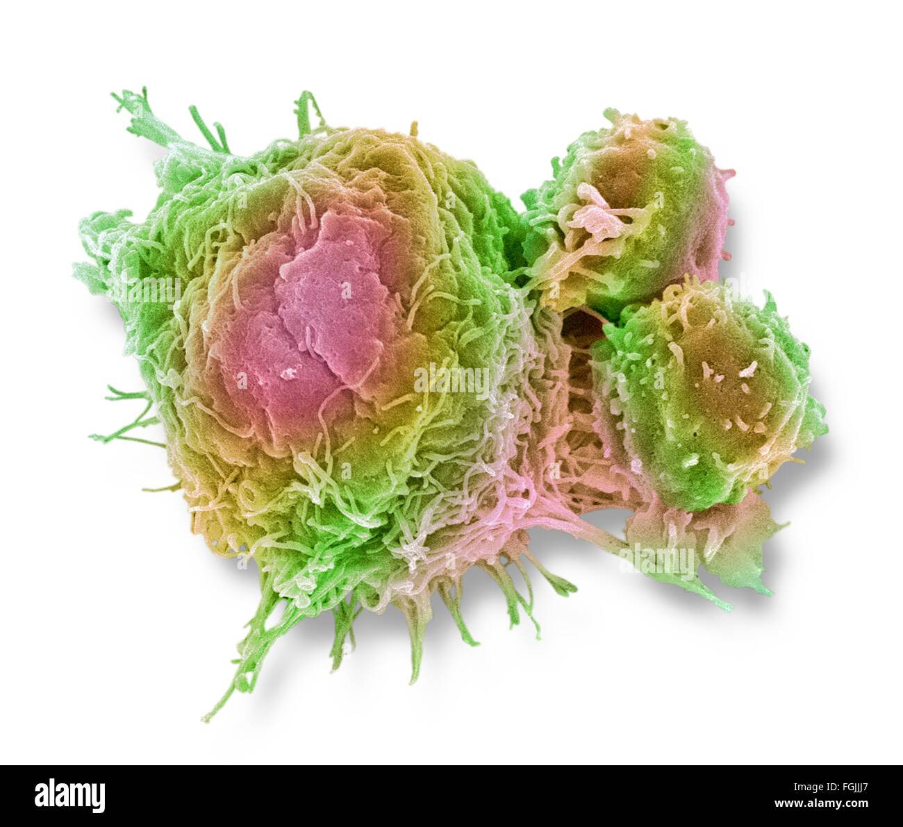 T lymphocytes and cancer cell. Coloured scanning electron micrograph ...
