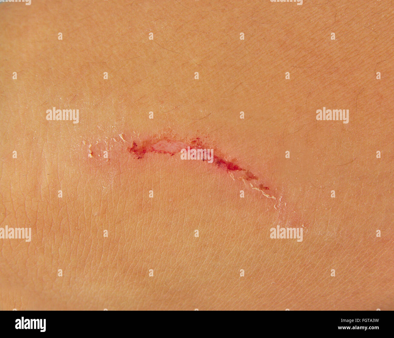 Scratch on a human skin on a white background Stock Photo - Alamy