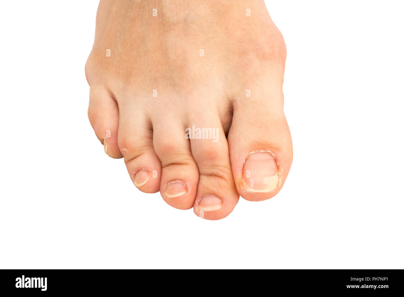 Cracked toe hi-res stock photography and images - Alamy