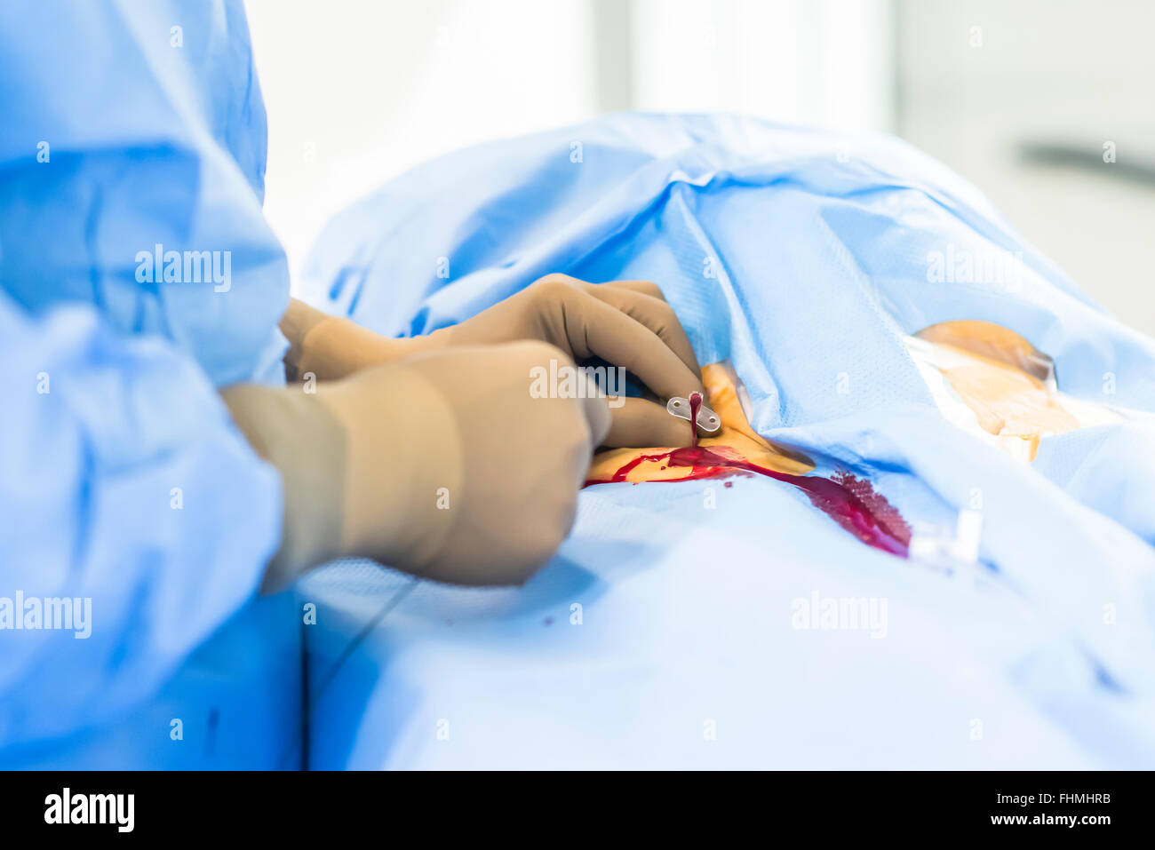 Surgon using guide wire hi-res stock photography and images - Alamy