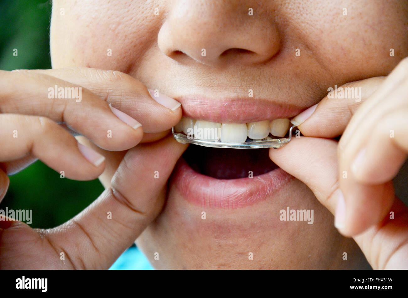 Thai woman putting Retainer fashion at tooth Stock Photo - Alamy