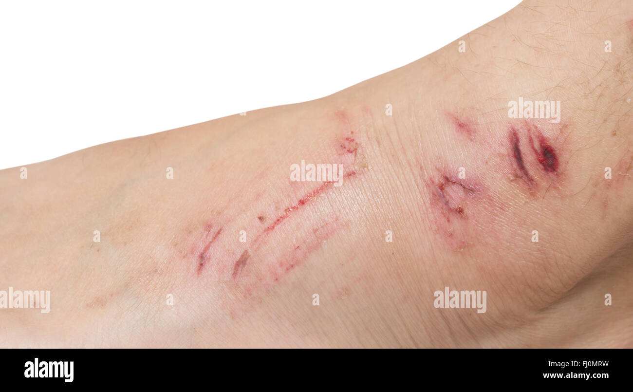 wounded foot isolated on a white background Stock Photo - Alamy
