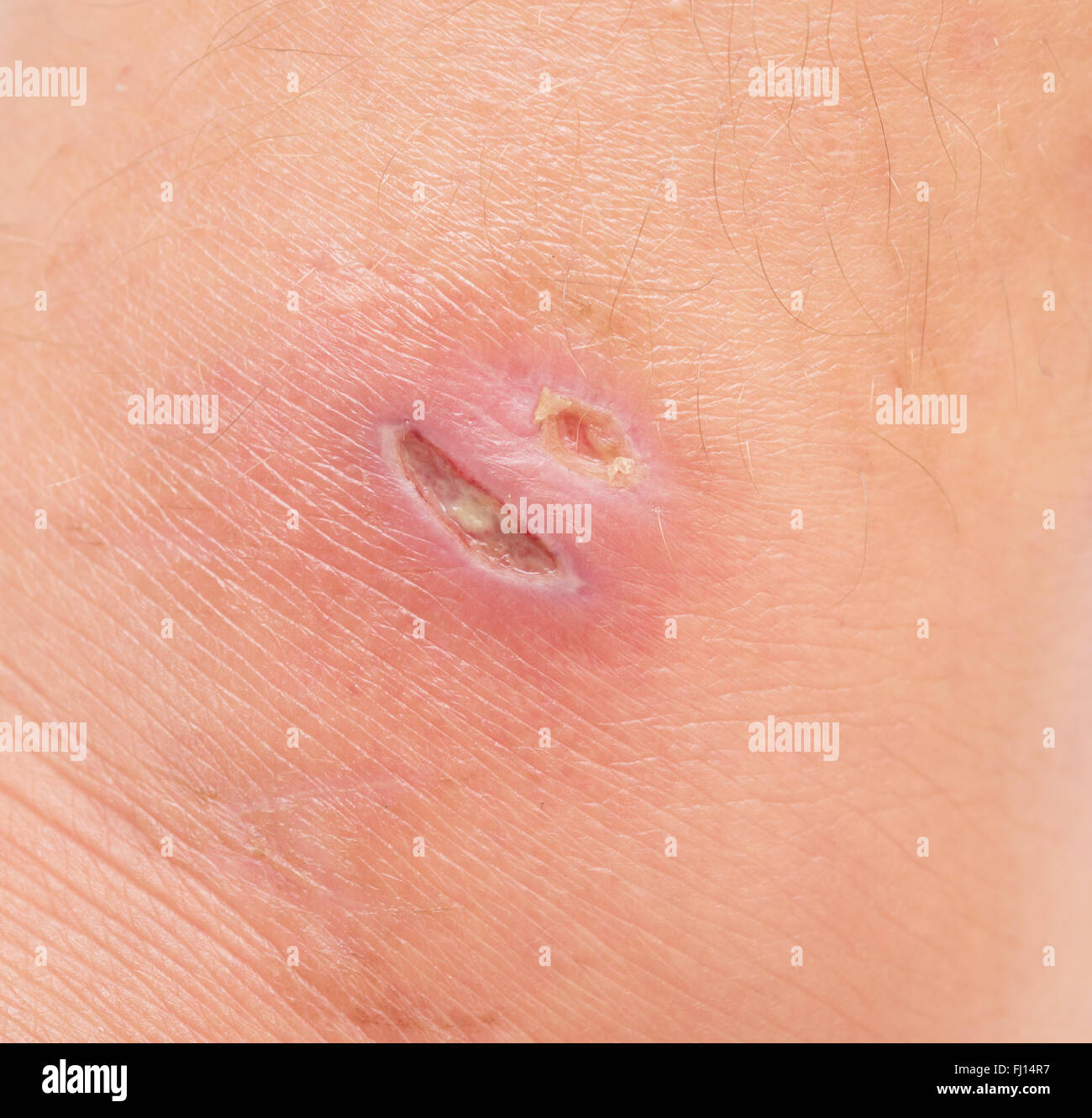 Pus Wound High Resolution Stock Photography and Images - Alamy