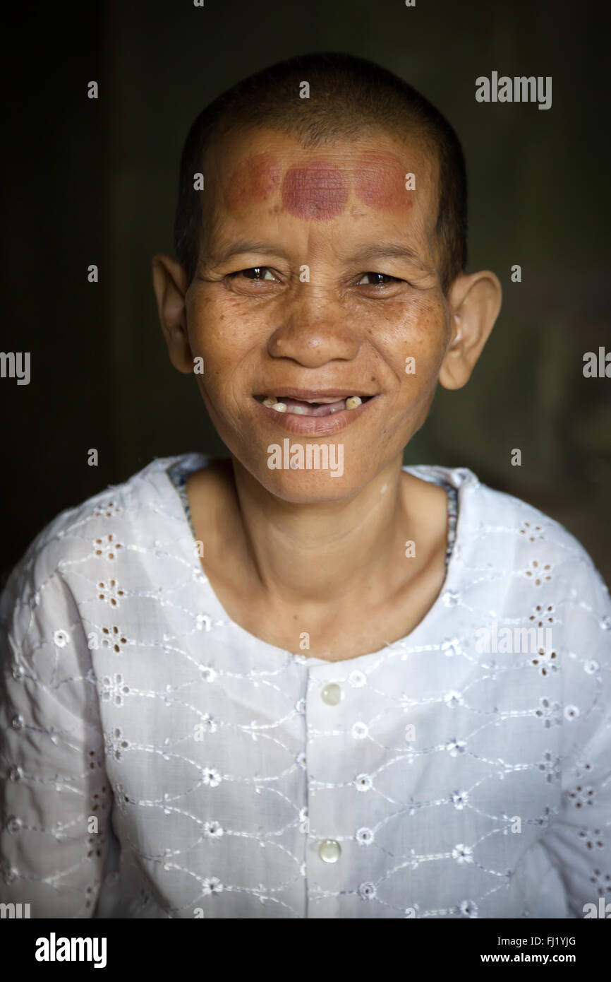 Cupping marks hi-res stock photography and images - Alamy