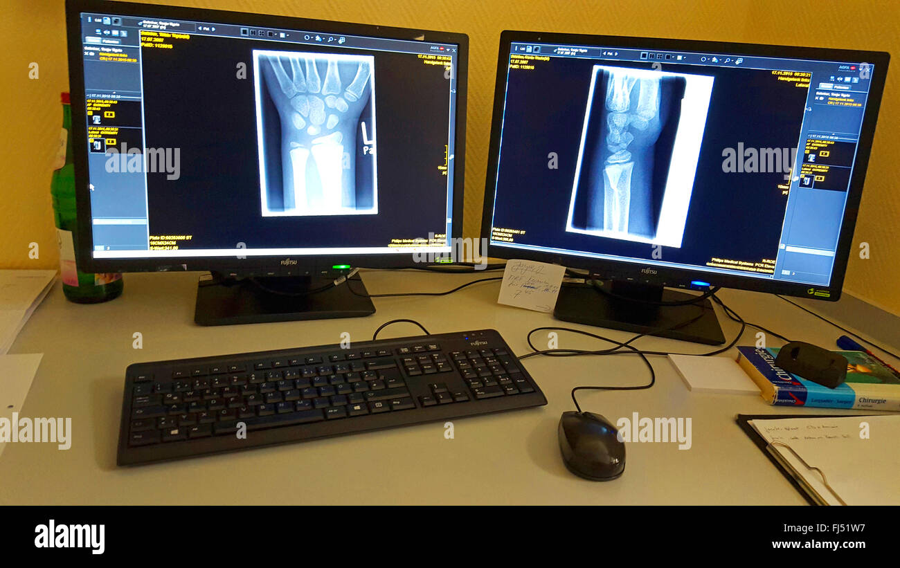 wrist fracture, x-ray photographs on computer screens Stock Photo - Alamy