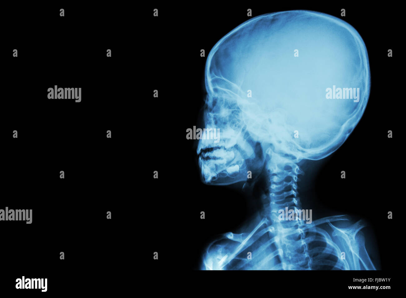 film x-ray skull and body of child ( blank area at left side Stock ...