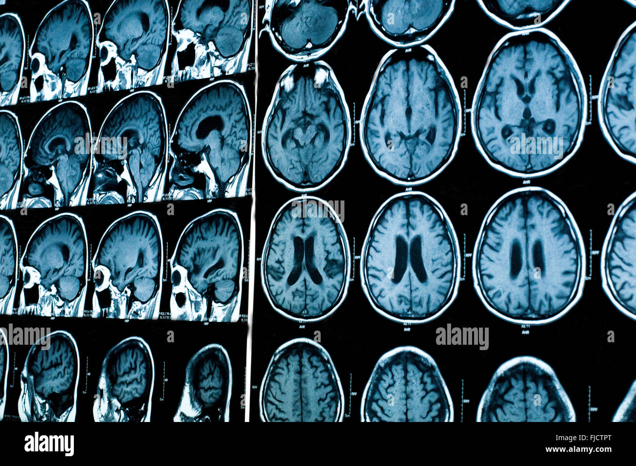 Brain ct scan patient hi-res stock photography and images - Alamy
