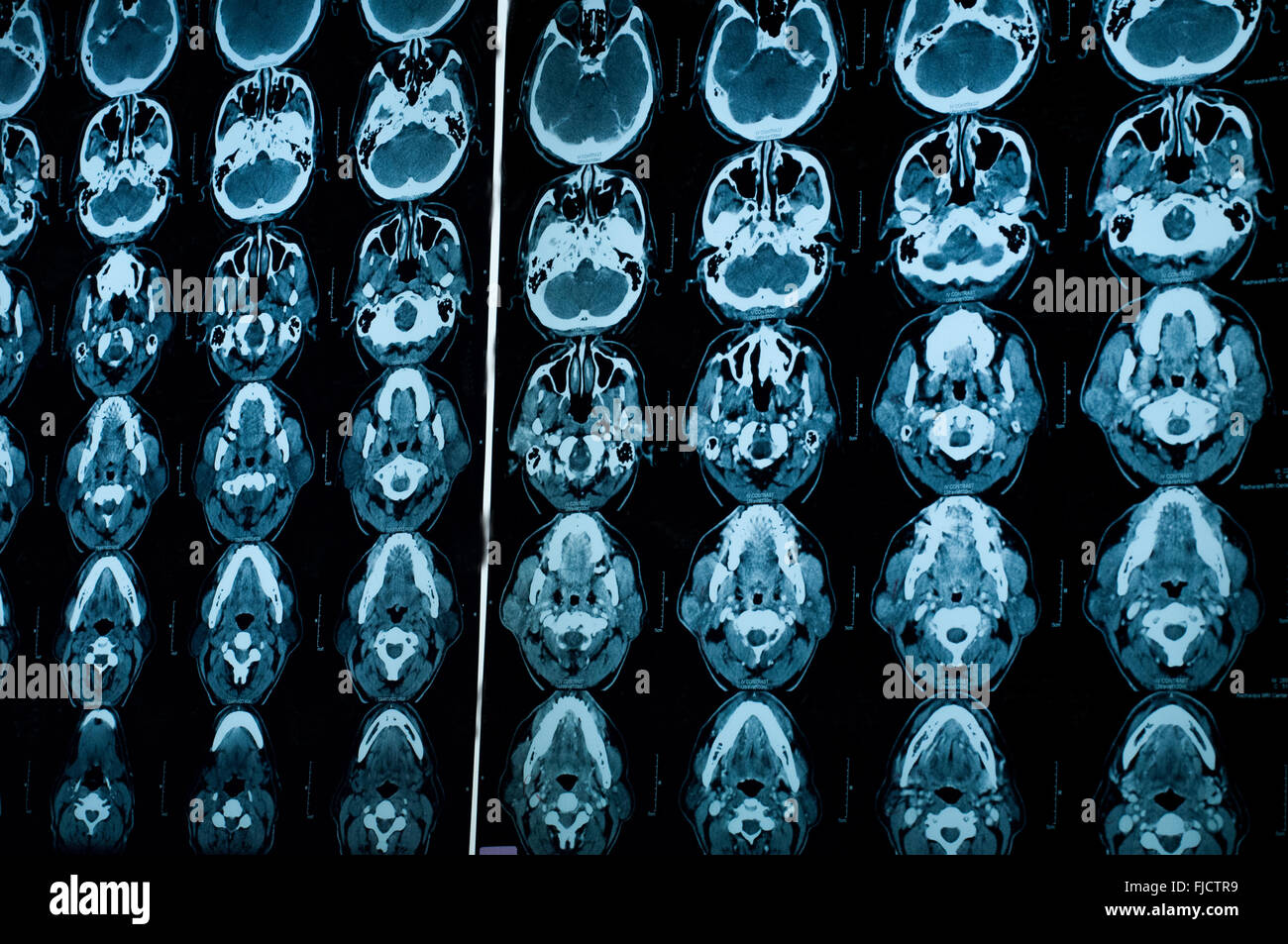 Ct scan brain hi-res stock photography and images - Alamy