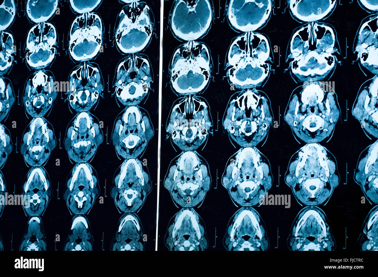 3d Ct Scan Head Stock Photos & 3d Ct Scan Head Stock Images - Alamy