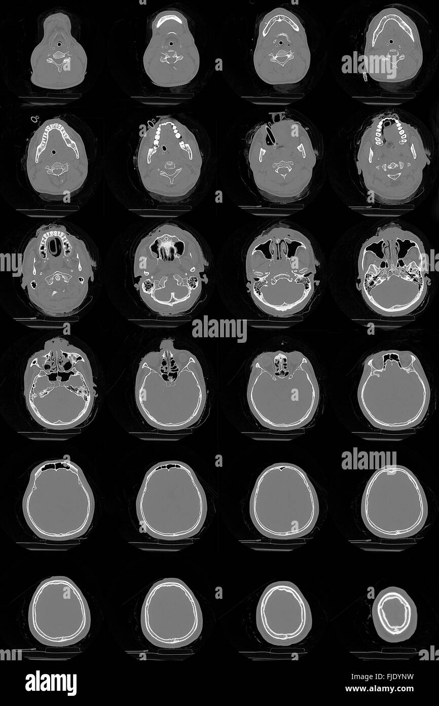 Ct test Black and White Stock Photos & Images - Alamy