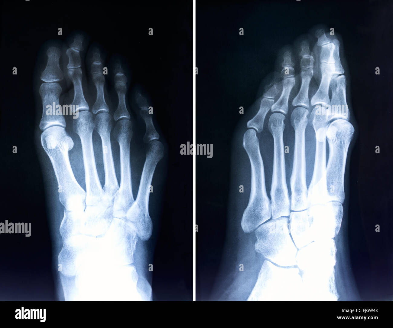 Finger deformation hi-res stock photography and images - Alamy