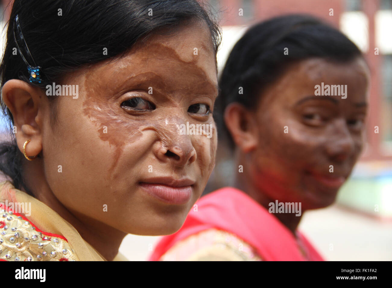 Dhaka, Bangladesh. 5 March 2016. Acid survivors attend the national ...