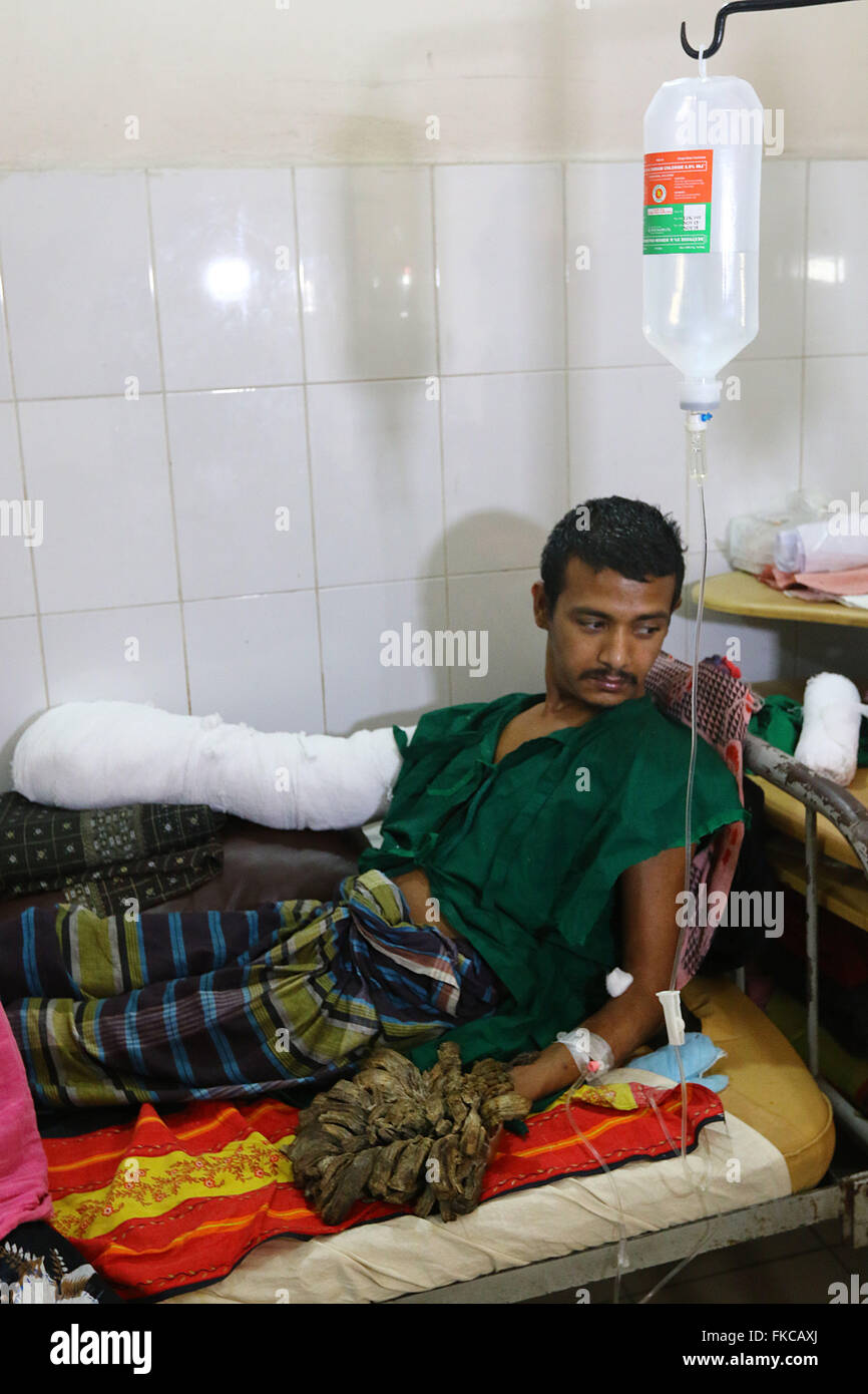 Bangladeshi Tree Man Abdul Bajander Rests After A Surgery At Dhaka