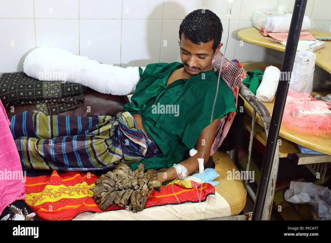Bangladeshi Tree Man Abdul Bajander Rests After A Surgery At Dhaka