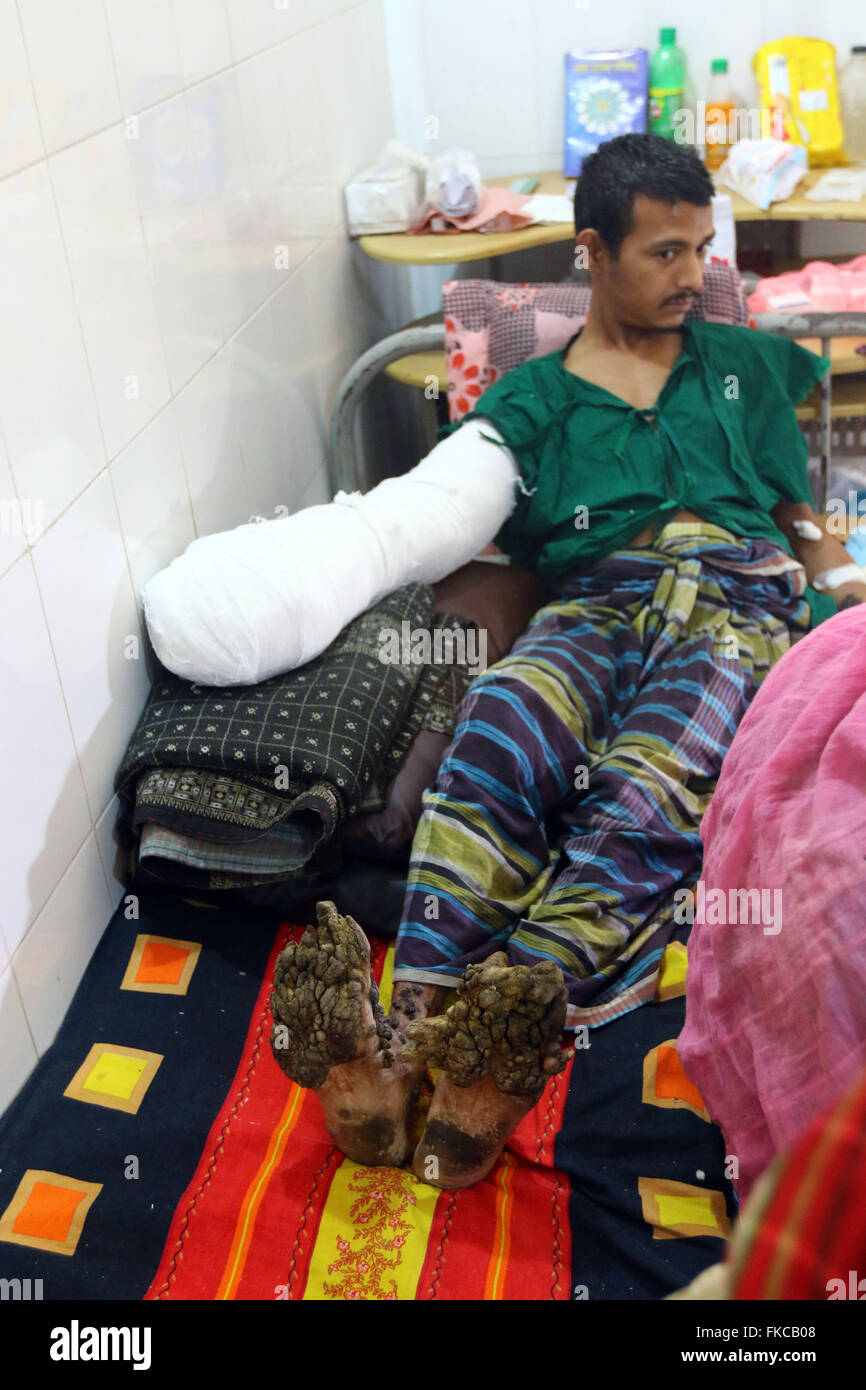 Bangladeshi Tree Man Abdul Bajander Rests After A Surgery At Dhaka