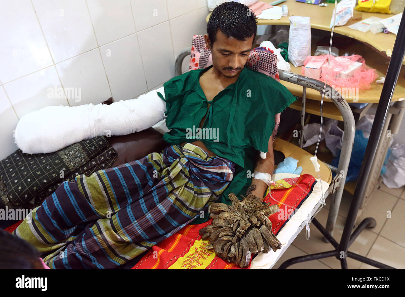 Bangladeshi Tree Man Abdul Bajander Rests After A Surgery At Dhaka