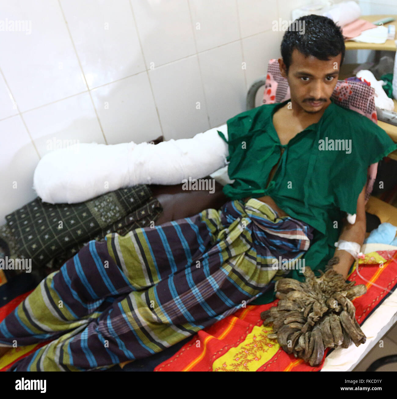 Bangladeshi Tree Man Abdul Bajander Rests After A Surgery At Dhaka