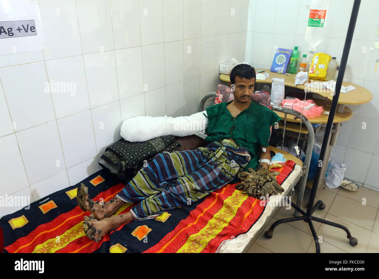 Bangladeshi Tree Man Abdul Bajander Rests After A Surgery At Dhaka