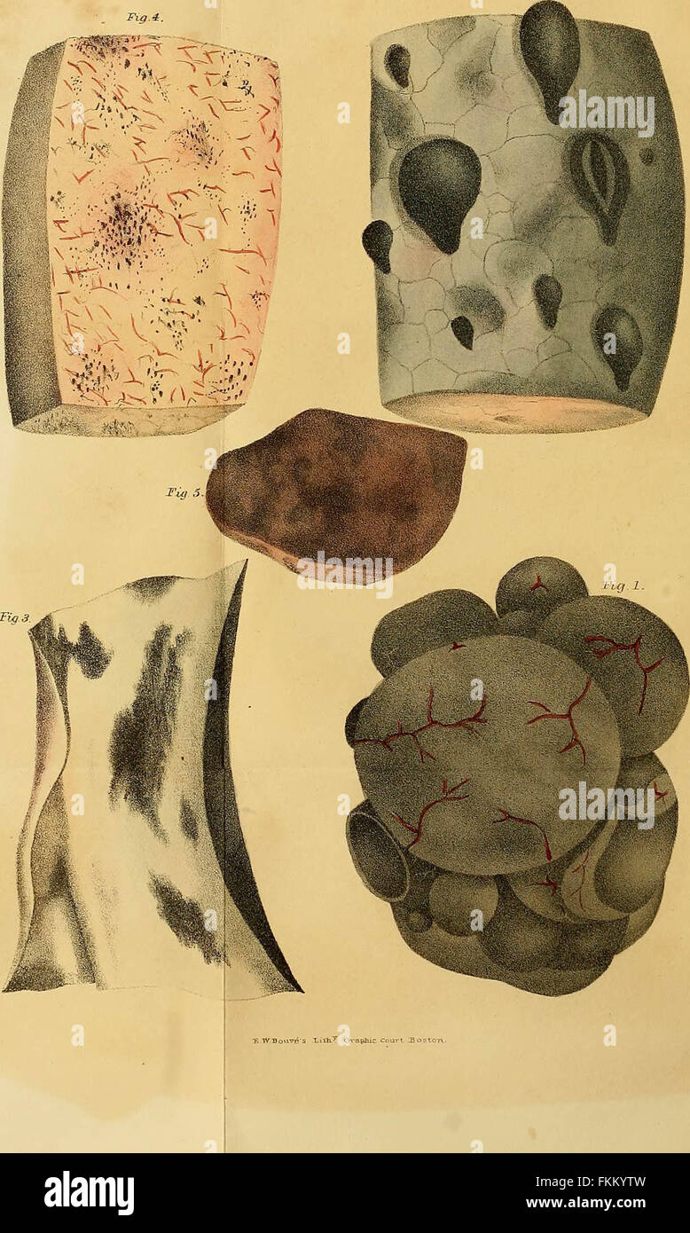 "Elements of pathological anatomy" (1843 Stock Photo - Alamy