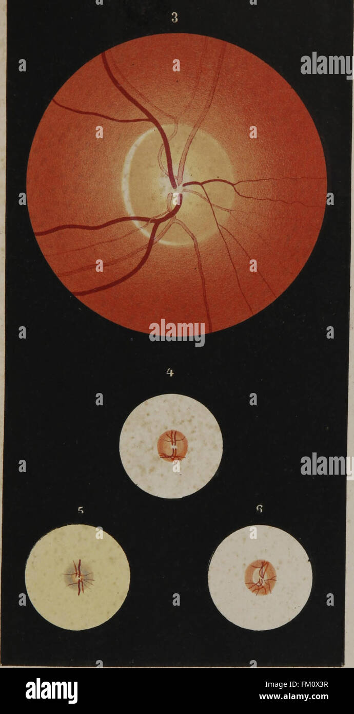 The human eye in health and disease - as seen with the ophthalmoscope ...