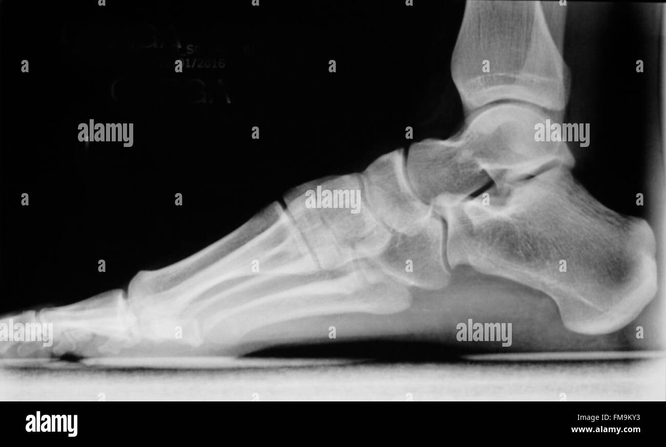 Foot, heel and toes injury Traumatology medical load bearing x-ray ...