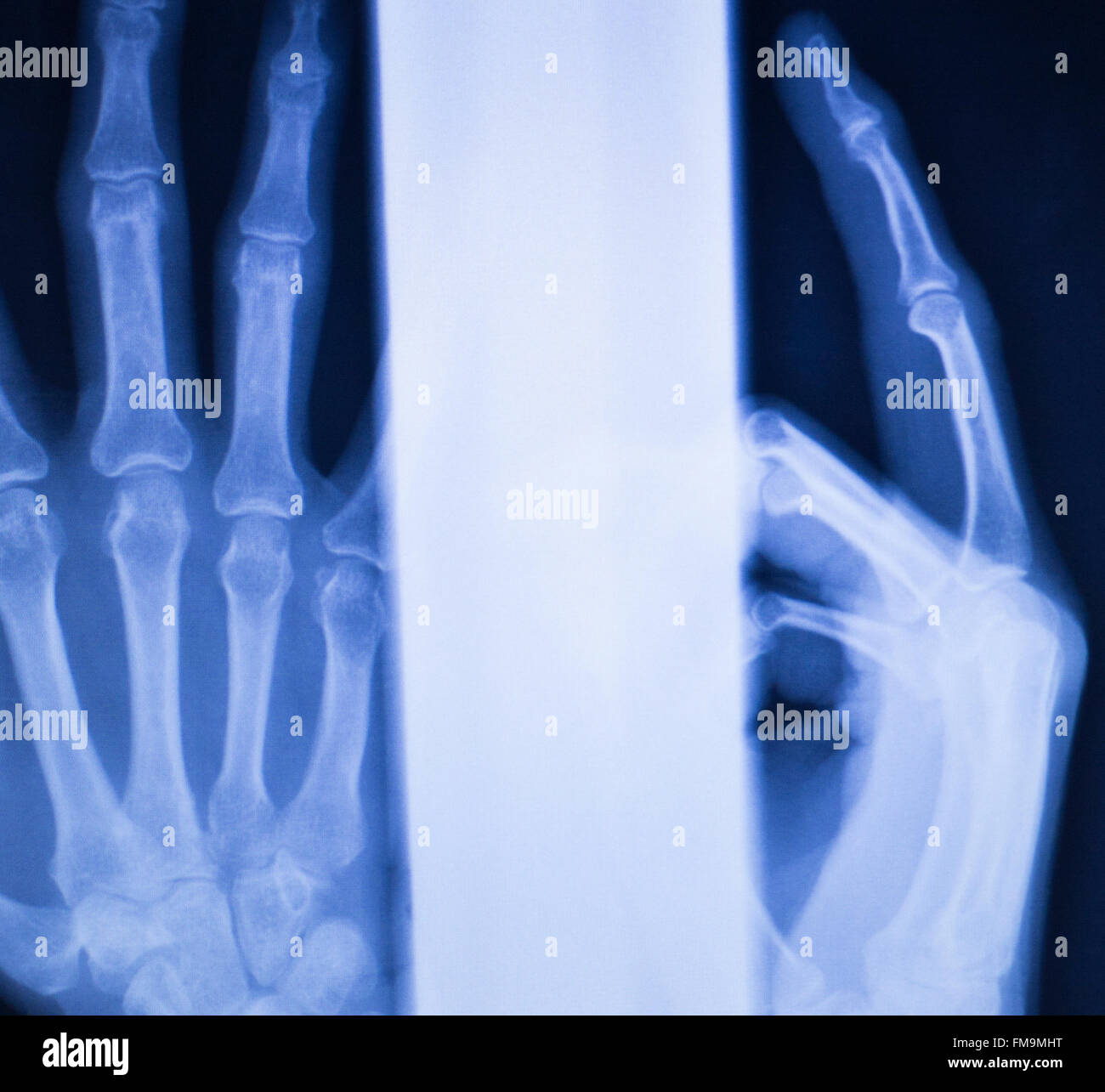 Hand, fingers, thumb and wrist injury orthopedic Traumatology medical x ...