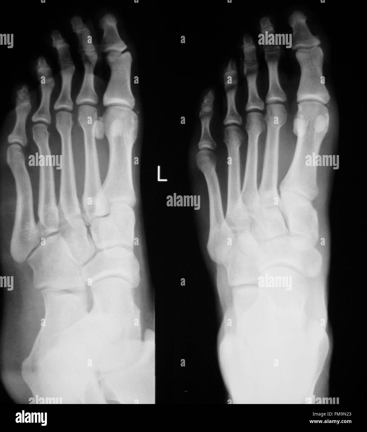 Foot and toes injury Traumatology medical x-ray Orthopedic test scan ...