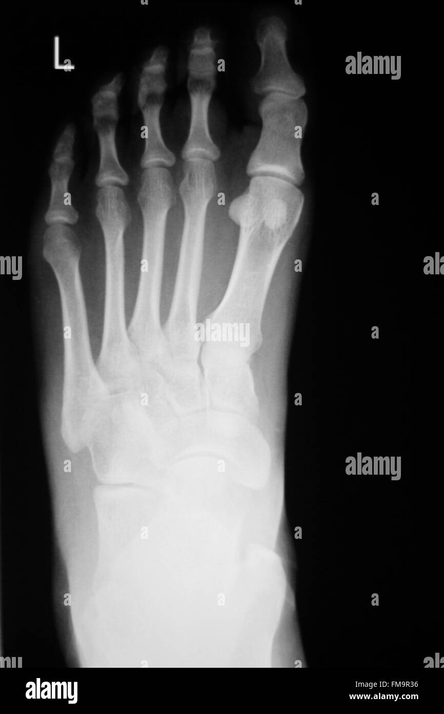 Foot and toes injury Traumatology medical x-ray Orthopedic test scan ...