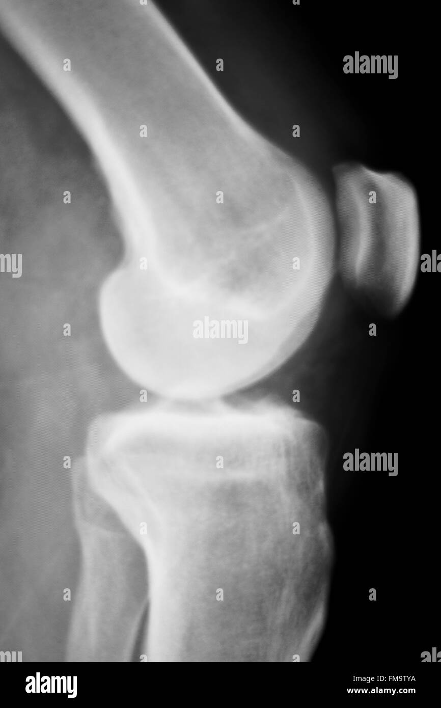 Knee and meniscus injury medical x-ray test scan result image Stock ...