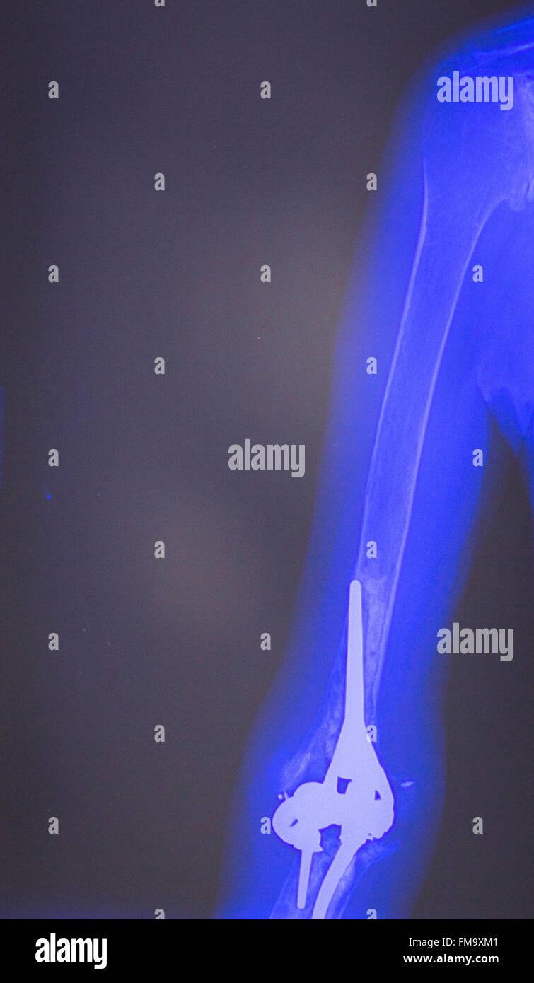 Elbow, arm and forearm orthopedic titanium metal replacement implant ...