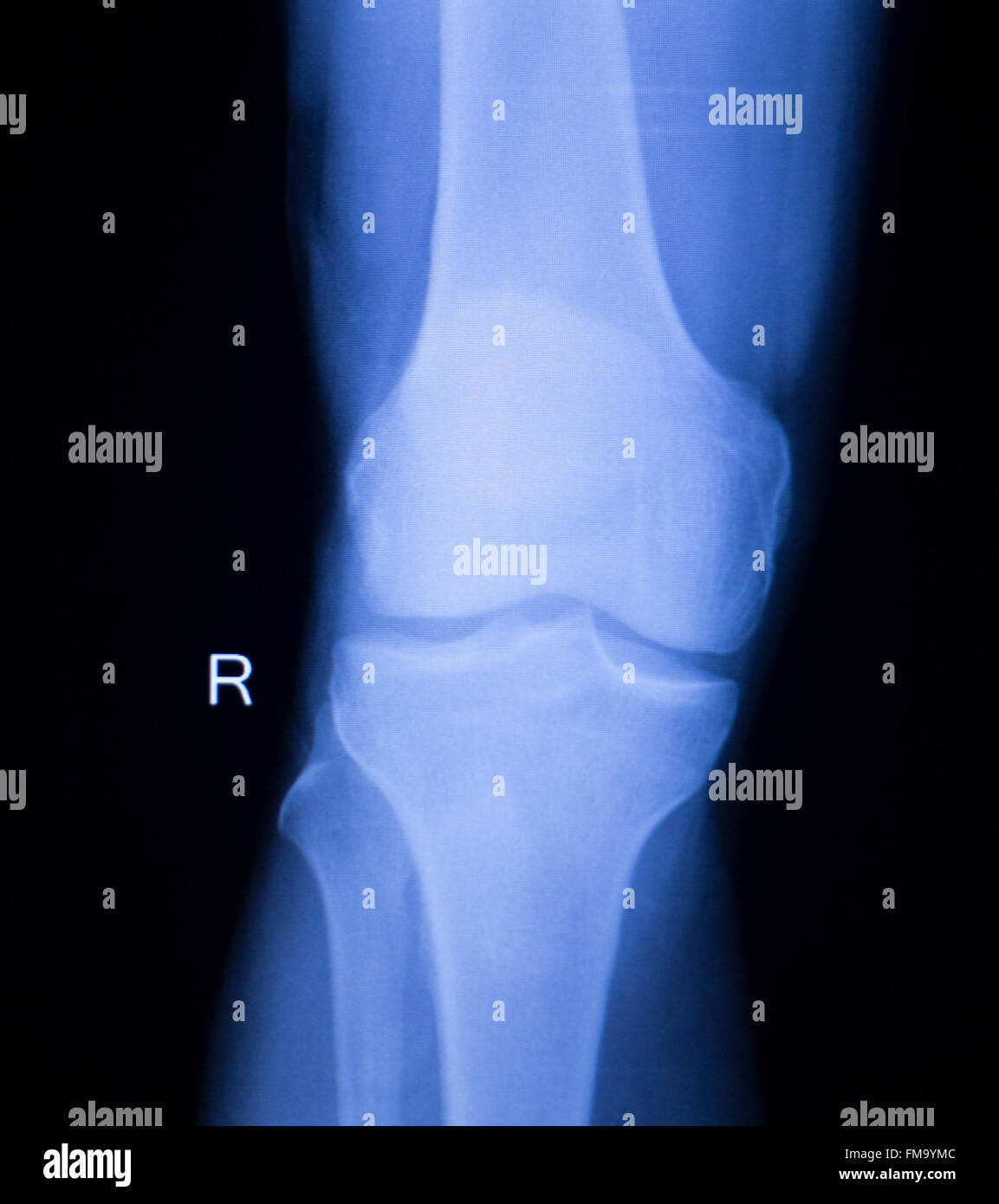 Knee and meniscus injury medical x-ray test scan result image Stock ...