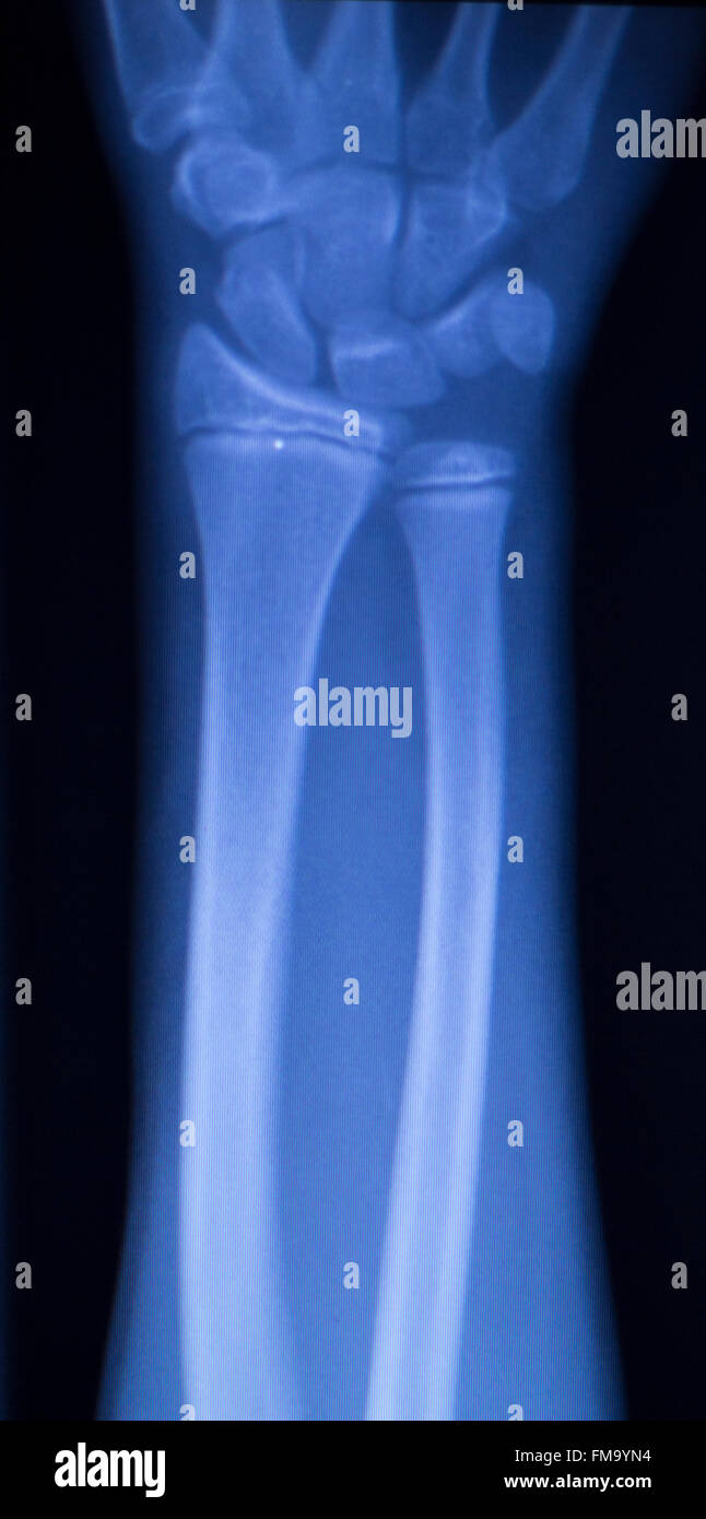 Hand, fingers, thumb and wrist injury orthopedic Traumatology medical x ...