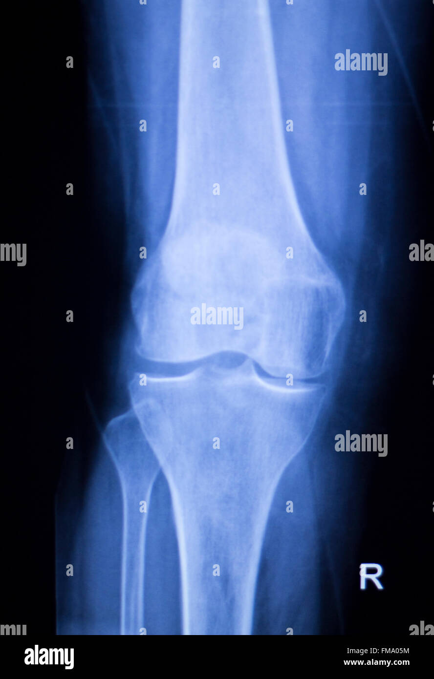 Knee and meniscus injury medical x-ray test scan result image Stock ...