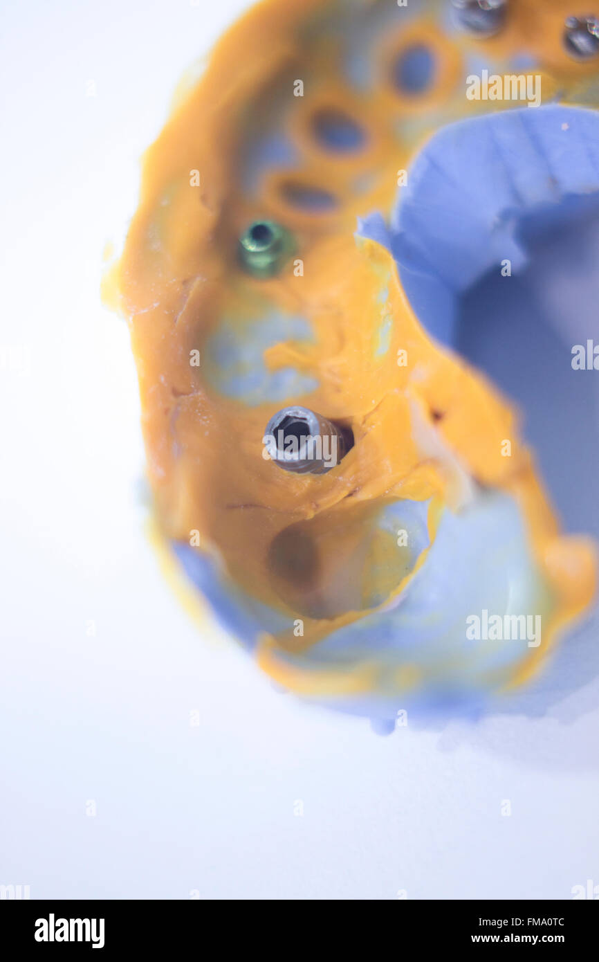 Dental mold dental impression plate in dentist's clinic Stock Photo - Alamy