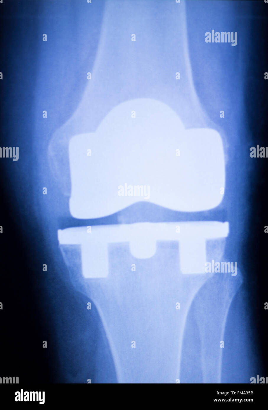 Knee joint meniscus orthopedic titanium metal replacement implant xray ...