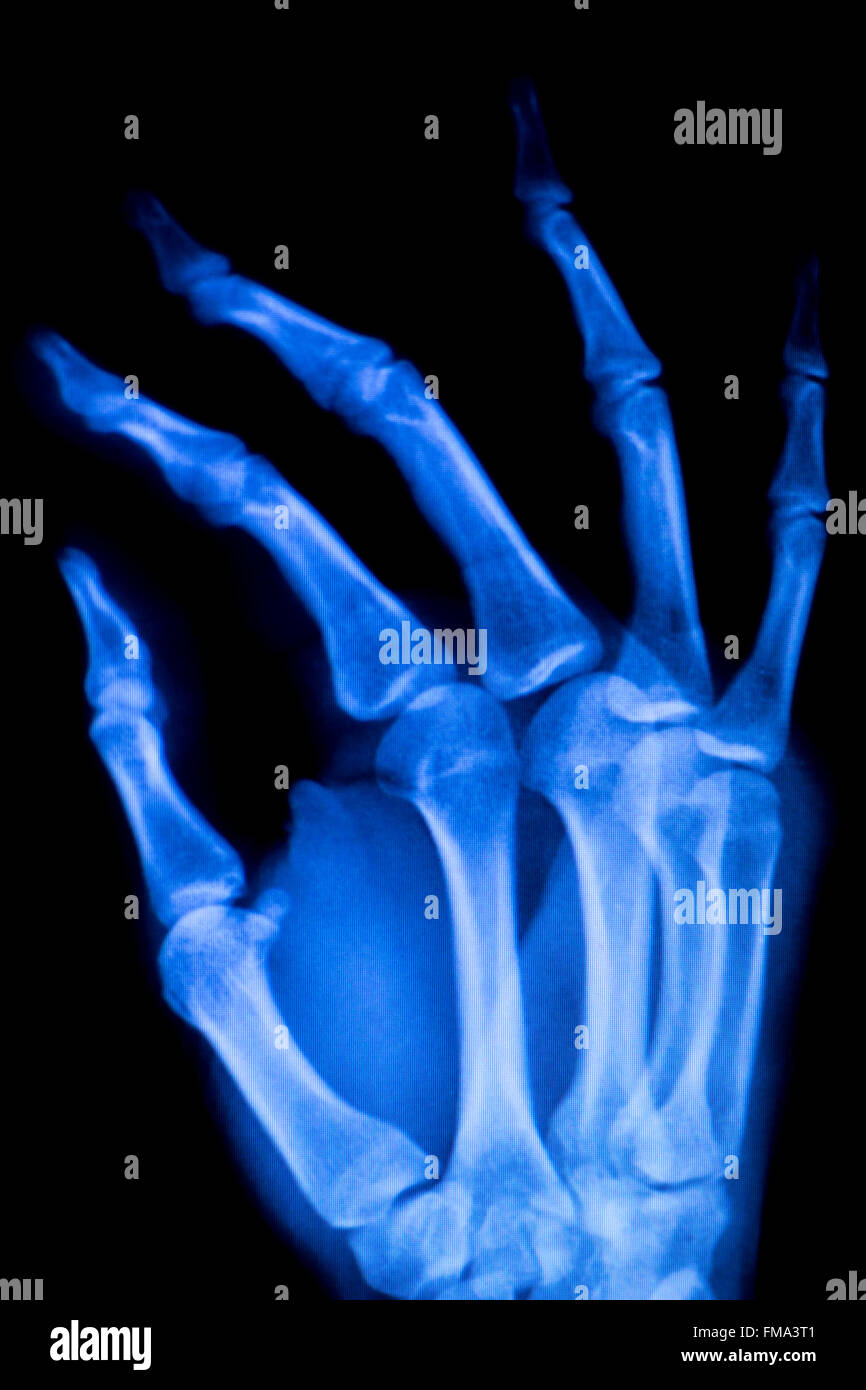 Hand, fingers, thumb and wrist injury orthopedic Traumatology medical x ...