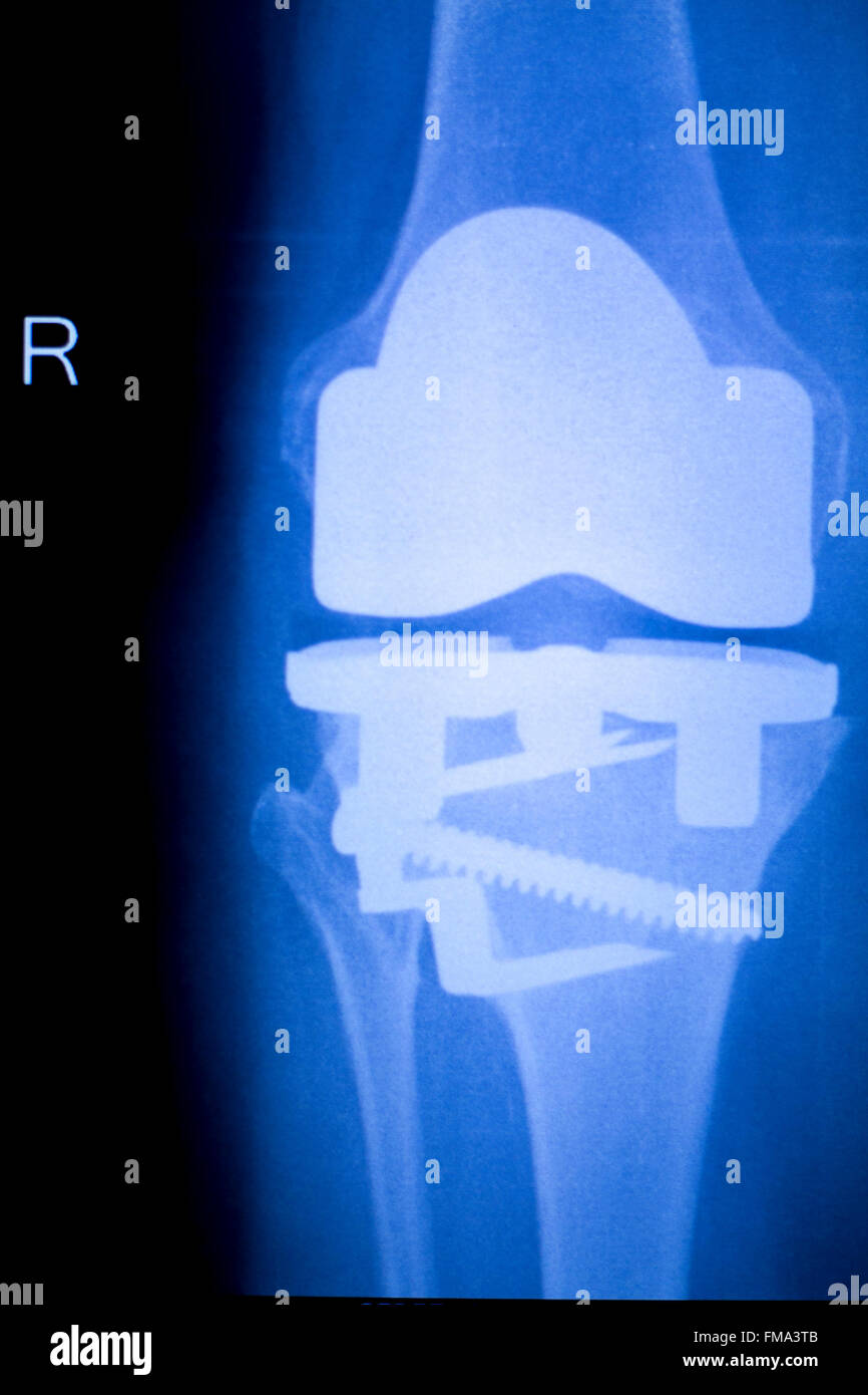 Knee and meniscus injury medical x-ray test scan result showing ...