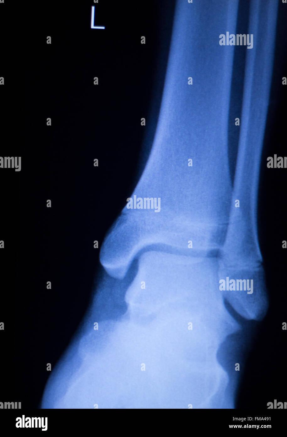 Shin, lower leg and ankle injury Traumatology medical x-ray Orthopedic ...
